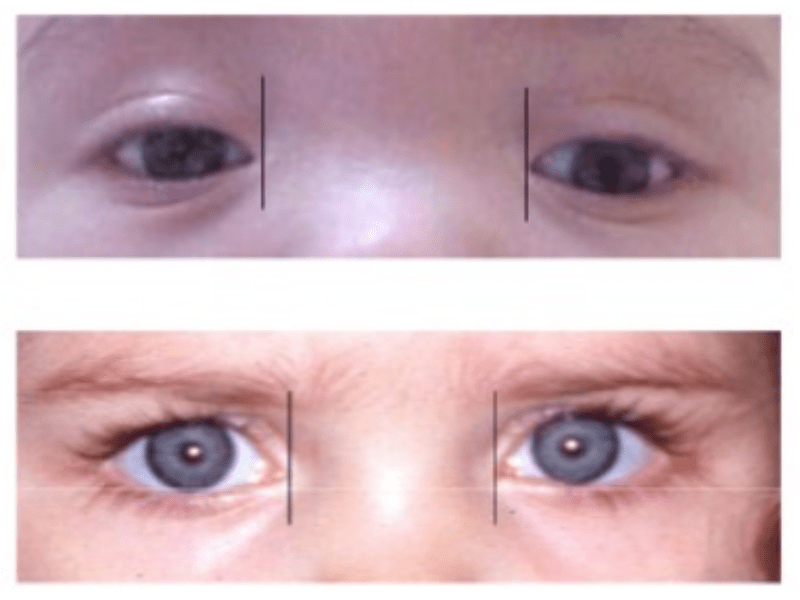 Le SEDmc - SED musculocontractural - SED in FRANCE